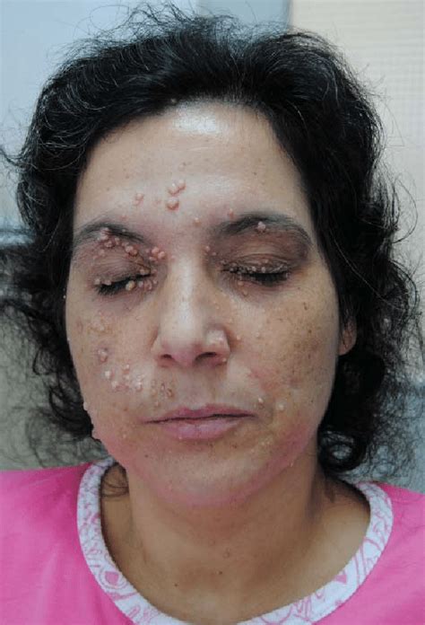 The Patient Had Multiple Lesions On The Face Abdomen And Genital Area Download Scientific