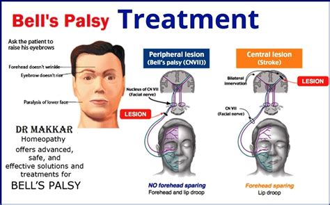 Bells Palsy Causes Symptoms And Treatment Ixxliq