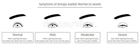 Medical Illustration Ptosis Symptoms Normal To Severe Stock Vector