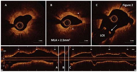 Oct Guidance In Bifurcation Pci Of Proximal Lcx And Lad Cardiology Apps