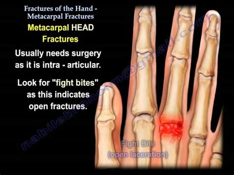 Metacarpal Head
