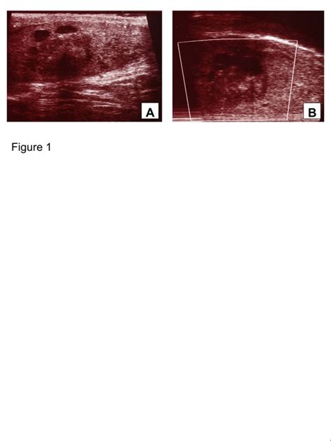 Rete Testis Ultrasound