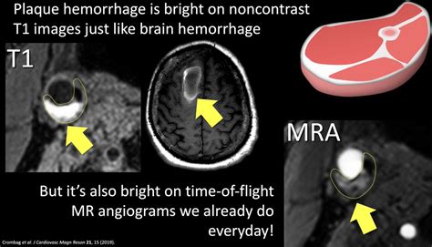 1the 90s Called And Wants Its Carotid Imaging Back Its Been 30 Years Why Are You Still Just