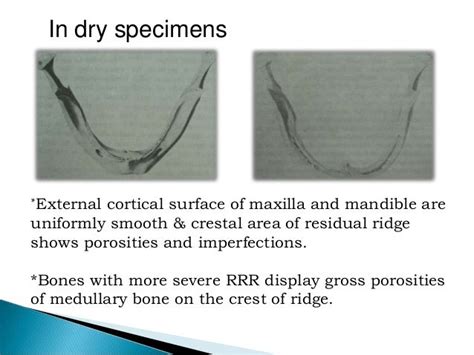 Residual Ridge Resorption