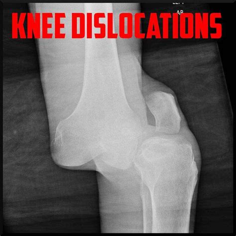 Dislocated Knee X Ray 4 Hundred Dislocation Ray Knee Royalty Free