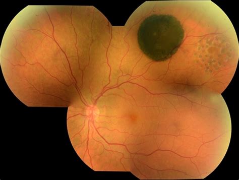 Chrpe Retina Image Bank