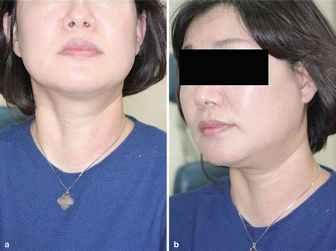 Robot Assisted Transaxillary Thyroidectomy Basicmedical Key