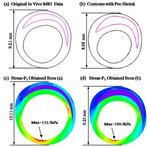 Morphological Plaque Vulnerability Index Mpsi Classifications And Download Table