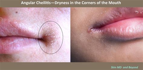 Dry Skin On Lips And Around Mouth