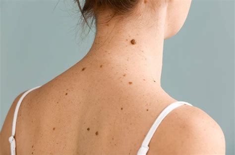 Advances In Ai Powered Skin Cancer Diagnosis Devices And Apps Revolutionizing Early Detection