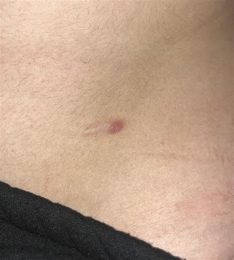 Pailful And Infected Appendectomy Scar Rdermatologyquestions