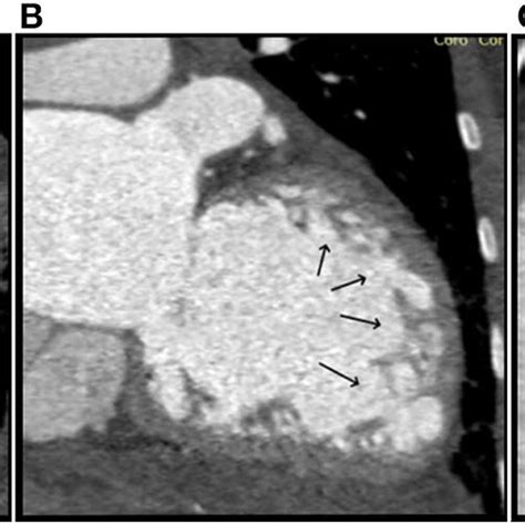 Case 2 Multi Detector Computed Tomography Mdct Angiography At The Download Scientific