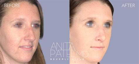 Septoplasty Before And After Gallery Dr Anita Patel