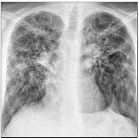 Cresp 1 Wk 27 Lecture 1 Bronchiectasis And Respiratory Infections
