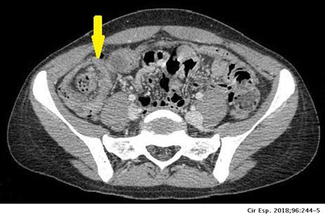 Ileocolic Intussusception By Appendicular Mucocele Cirugía Española English Edition