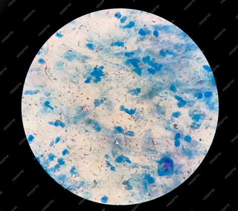 Premium Photo Sputum Or Phlegm Smear Afb Stain Under Microscopy Showing Macrobacterium