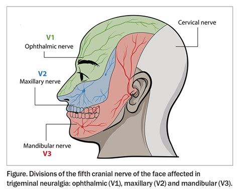 Trigeminal Neuralgia Management In Primary Care Pain Management Today