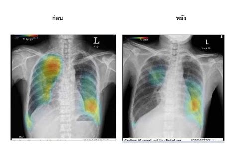 💫💫ภาพเอ็กซเรย์ผู้ป่วยมะเร็งปอด Herborgthailandpage