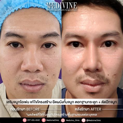 สิ้นสุดการรอคอยยยย สำหรับจมูกผู้ชายเคสยากสุดหิน รีวิวจมูกผู้ชาย จมูก