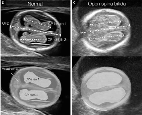 Choroid Plexus Ultrasound