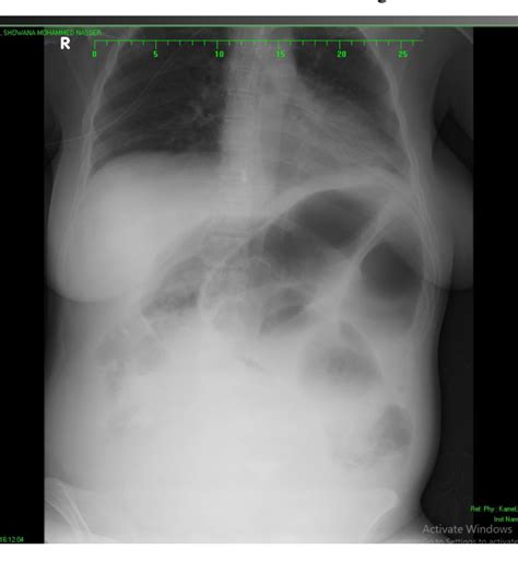 Figure 1 From Ileosigmoid Knotting Case Report And Literature Review Semantic Scholar