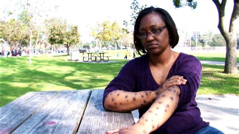 Woman Gets Bug Bite Mowing Her Lawn Days Later Dark Spots Appeared All Over Her Body