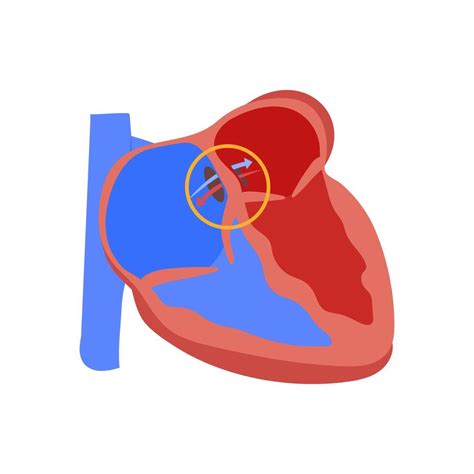 Atrial Septal Defect Cardiovascular Disease Illustration Icon 53307957