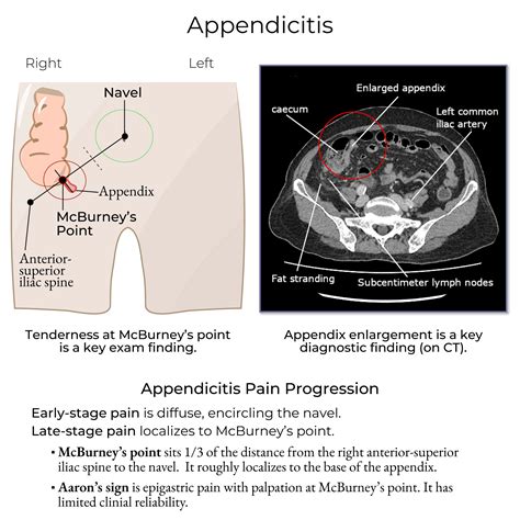 Base Of Appendix
