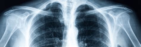 X Ray Alfred Health