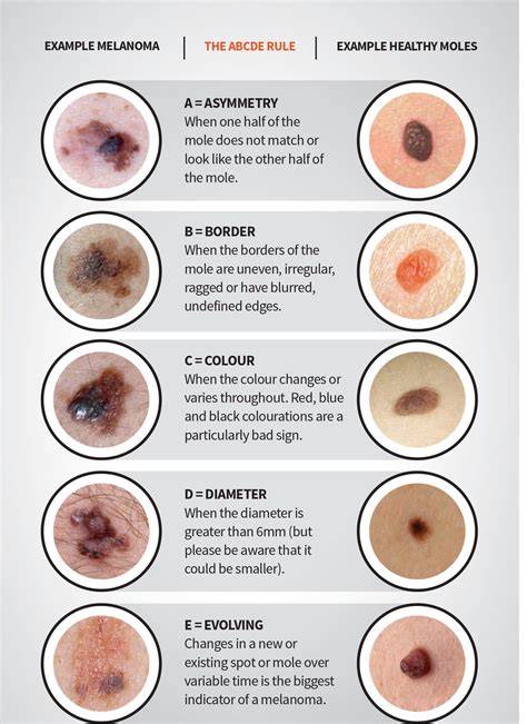 Melanoma Artofit