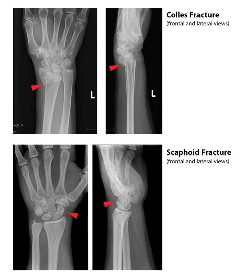 Upper Limb Bonesjointsmusclesdrbbgosai