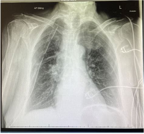 Video Atlas Of Pulmonary Segmentectomy Robotic Assisted Right S3