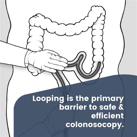 Looping During Colonoscopy Remains The Biggest Barrier For Safe And Efficient Colonoscopy
