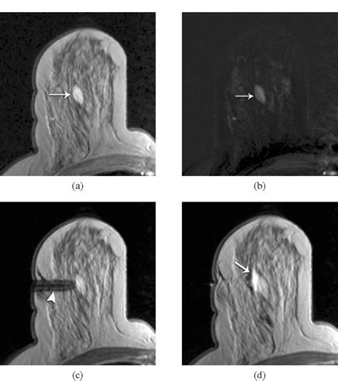 Radio Guided Occult Lesion Localisation For Breast Lesions Under