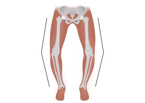 زانوی پرانتزی علت، علائم، تشخیص و درمان آن دکترمهرآیین