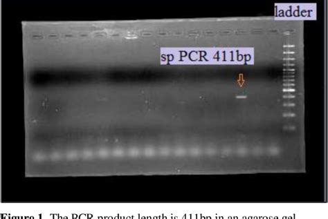 Figure 1 From Prevalence Of Drug Resistant Recurrent Tuberculosis And New Multidrug Resistant