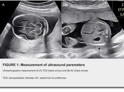 Figure 1 From Role Of Transcerebellar Diameter And Transcerebellar Diameterabdominal