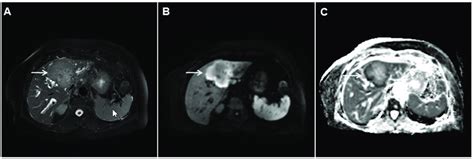 Mass Forming Intrahepatic Cholangiocarcinoma In The Left Liver Lobe Of Download Scientific