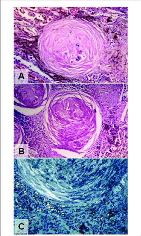Silicosis Of The Lung And Lymph Nodes Was Defined As Presence Of Download Scientific Diagram