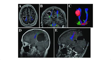 Merged Dti Sequence And Contrast T1 Weighted Mri Revealing The Download Scientific Diagram
