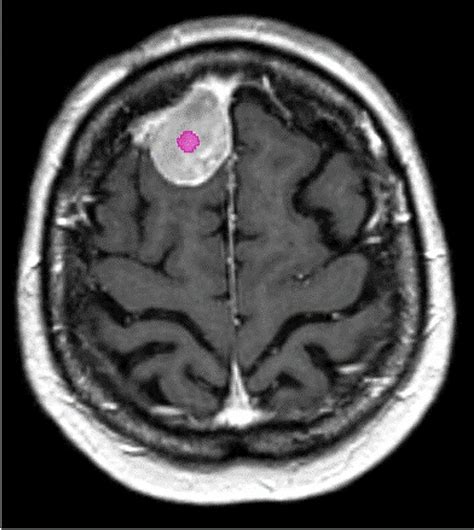 Pyradiomics Segmentation Right High Frontal Meningioma With An
