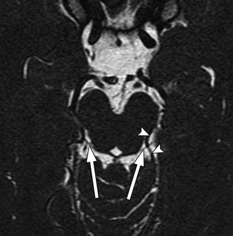 Trochlear Nerve Mri