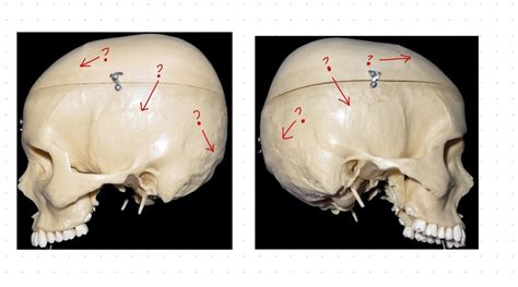 Coronal Sutures Diagram Quizlet
