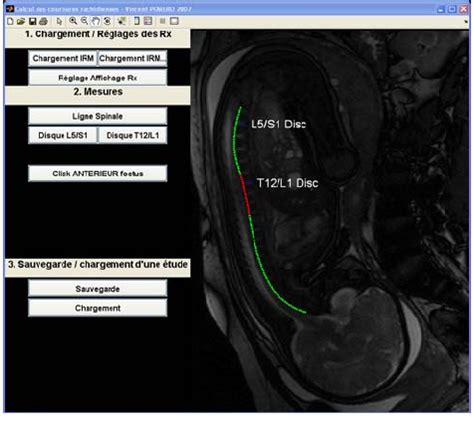 Steps In Measuring Spine Curvature Download Scientific Diagram