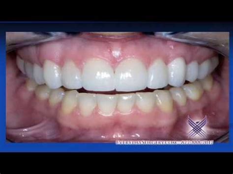 Dr Wong Speaks About Gum Graft Alternatives Route 66 Implants