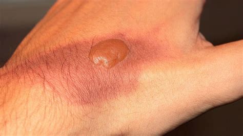 Tips For Skin Burns చర్మంపై కాలిన గాయాలు త్వరగా తగ్గాలంటే ఈ చిట్కాలు