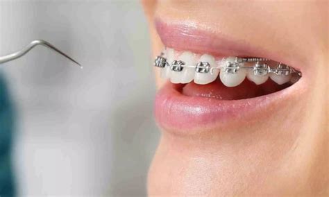 Ai Tool For Braces By 3shape Preeti Cholleti Posted On The Topic Linkedin