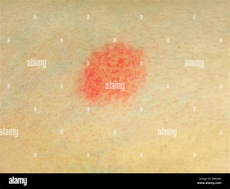Identifying 21 Common Red Spots On Skin Universal Der
