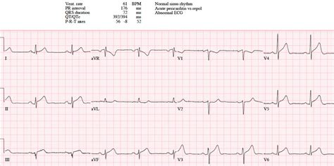 Lateral Stemi Or Occlusion Mi Ecg Cases Emergency Medicine Cases