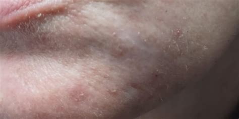 Subcision Or Excision Rplasticsurgery